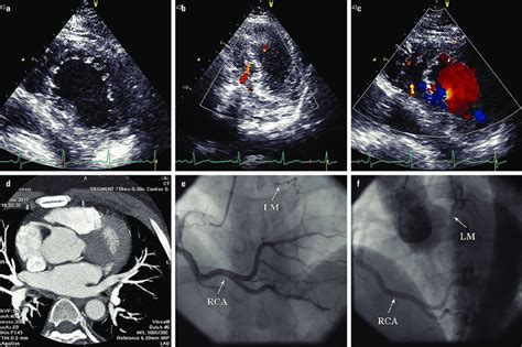 Echocardiography Shows A Left Ventricular Noncompaction With Download Scientific Diagram
