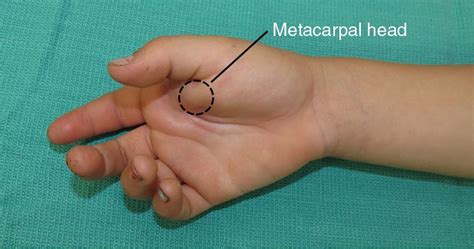 Open Reduction For Metacarpophalangeal Joint Dislocation Clinical Tree