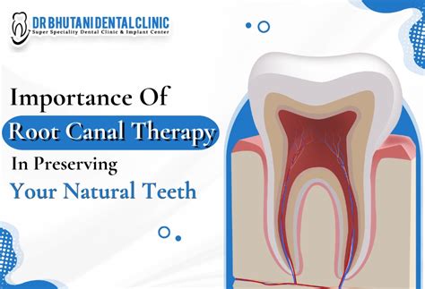 Importance Of Root Canal Treatment In Preserving Your Teeth