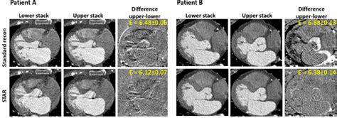 results for patients a and b roi from axial slices adaptive smoothing