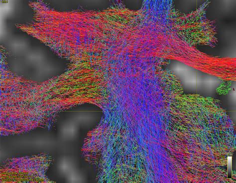 Global Tractography Results Are Not Good Tractography Mrtrix3 Community