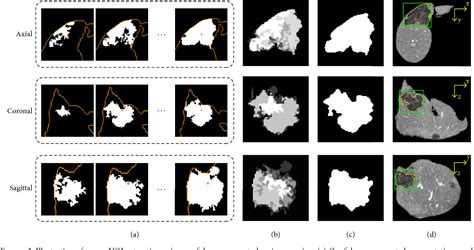 Figure 3 From 3d Liver Tumor Segmentation In Ct Images Using Improved