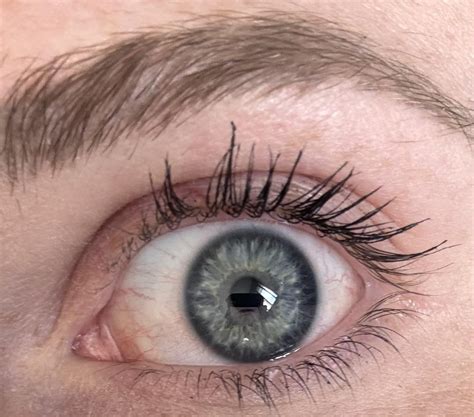 Are My Eyes Jaundice Rmedicaladvice