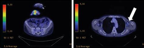 Fdg Pet Ct Findings Showing Avidity Involving The Full Thickness Of The