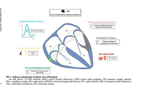 Prolapso Arritmog Nico De La V Lvula Mitral Y Ms Card Aca