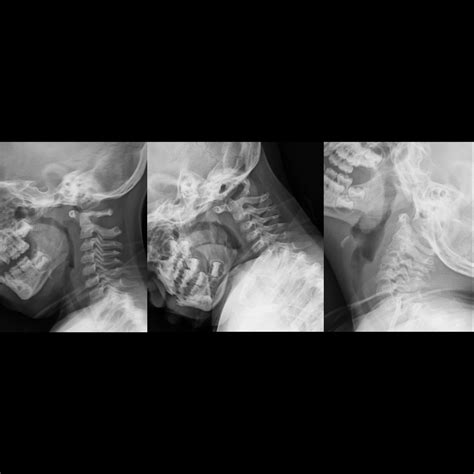 Atlantoaxial Instability Down Syndrome X Ray At Scott Lanier Blog