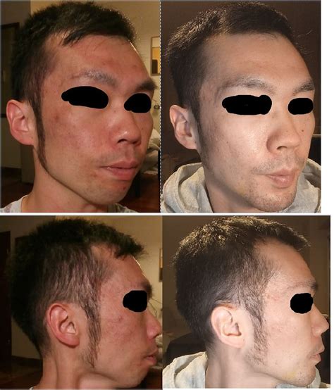 Sliding Genioplasty Beforeafter Pics Post Op Day 25 Scrolller