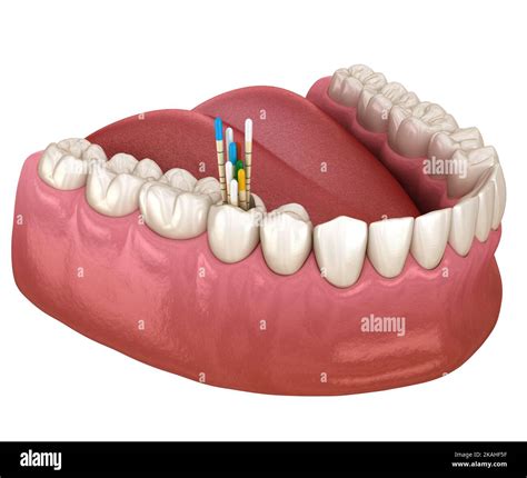 Root Canal Tooth Gutta Percha At Jesse Banks Blog