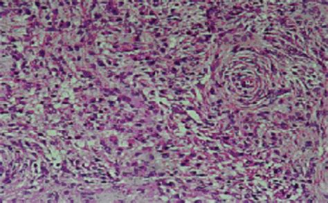 Case 2 Histological Features Of Transitional Meningioma Download