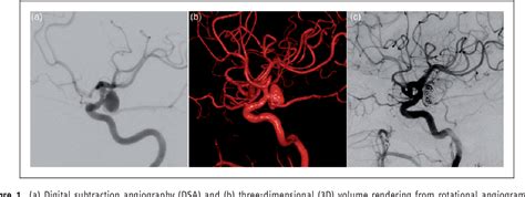 Figure 1 From Pipeline Embolization Device Deployment Via An Envoy