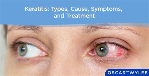 Keratitis Types Cause Symptoms And Treatment