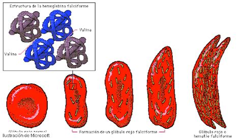 HISTORIA DE MI VIDA ANEMIA FALCIFORME