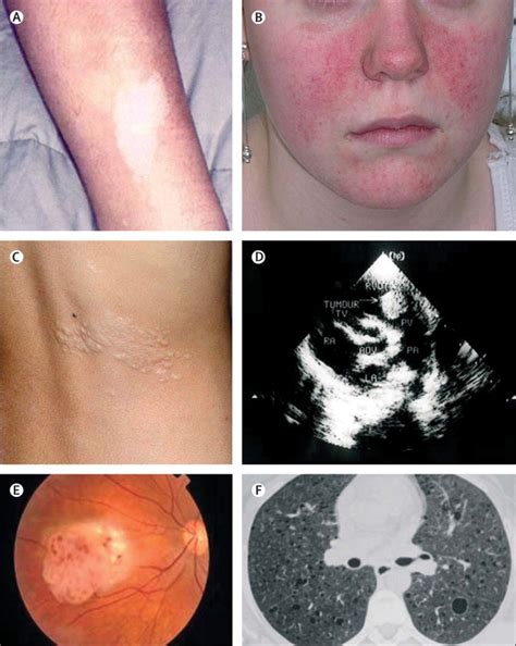 Tuberous Sclerosis Shagreen Patch