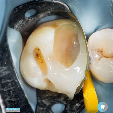 The Best Capping Material Myzerodonto