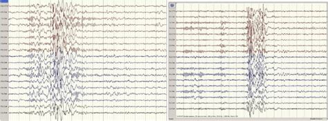 Eeg Revealed Generalized Epileptiform Discharges Download Scientific Diagram