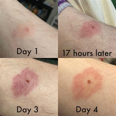 Does This Look Like A Bullseye Rash To Anyone Im Not Really Sure Lyme