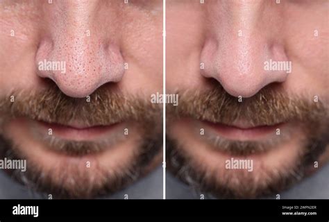 Blackhead Treatment Before And After Collage With Photos Of Man Closeup View Stock Photo Alamy