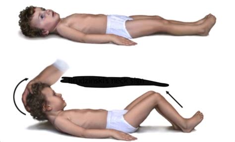 Meningitis Flashcards Quizlet