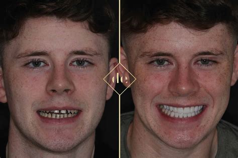 Dentist Composite Technique At Peggy Bradley Blog