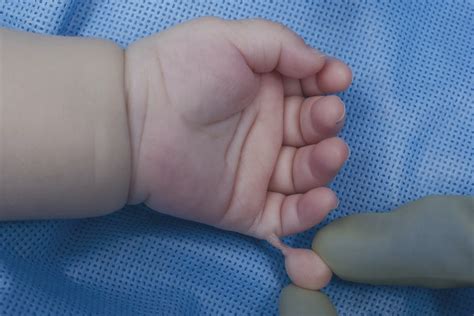 Newborn Polydactyly
