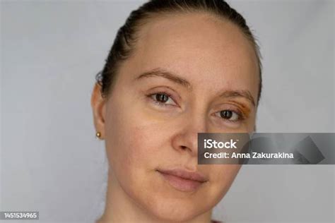 성형 수술 안검 성형술 눈에 보이는 눈 상처 부은 눈 주머니 부은 피부 봉합사 및 타박상 눈꺼풀 후 여성 얼굴 회복 과도한 피부 지방을 제거하는 성형 수술 30 34세에