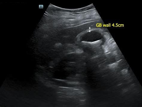 Acute Cholecystitis Ultrasound