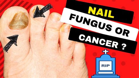 Subungual Melanoma Deadly Form Of Nail Cancer Or Fungal Nail Infection Youtube