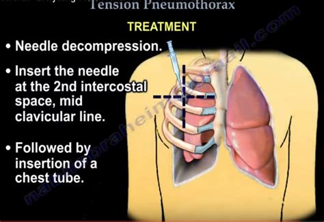 Tension Pneumothorax —