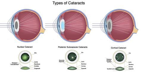 Cataract Surgery Procedure Safety Recovery And Effects
