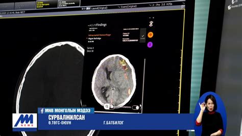 Хиймэл оюун ухаанд суурилсан программ эрүүл мэндийн салбарт нэвтэрч эхэллээ 2020 05 19 Youtube