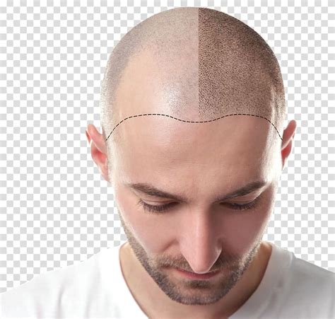 Scalp Makeup For Alopecia Saubhaya Makeup