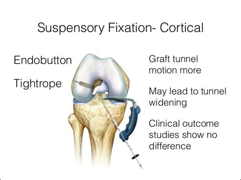 Acl Graft Fixation Options Acl Graft Fixation Options