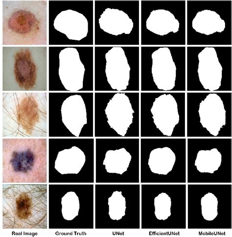 Figure 5 From Embedded Skin Lesion Segmentation Using Lightweight