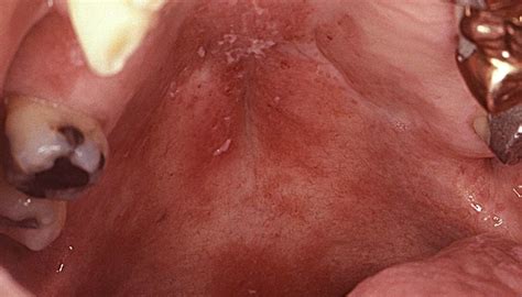 Mild Oral Thrush Roof Of Mouth