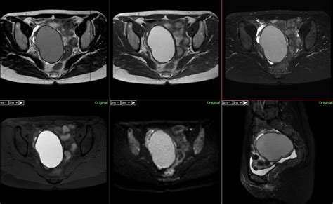 卵巣癌（ovarian Cancer）