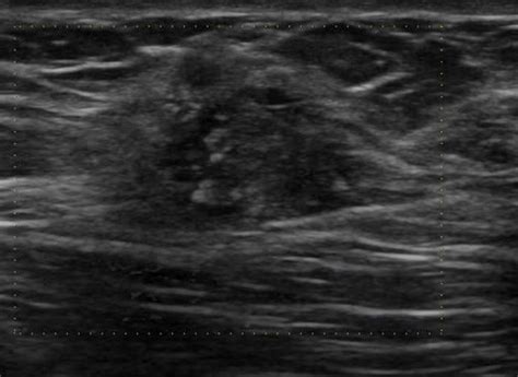 Breast And Axilla 52 Malignant Breast Lesions Case 522 Breast