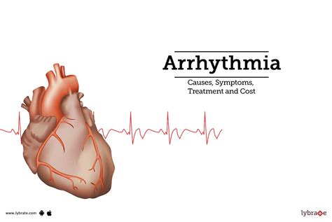 Arrhythmia Causes Symptoms Treatment And Cost