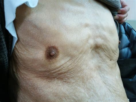 Galactorrhea Induced By Risperidone Pmc