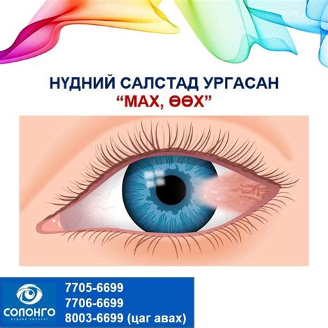 Нүдний өөх гэж юу Solongohospital Mn