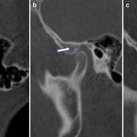 Pdf Evaluation Of Pneumatization In The Articular Eminence And Roof Of The Glenoid Fossa With