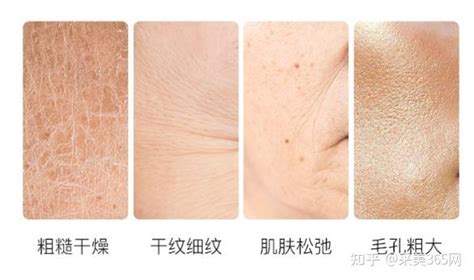 Superbfacial