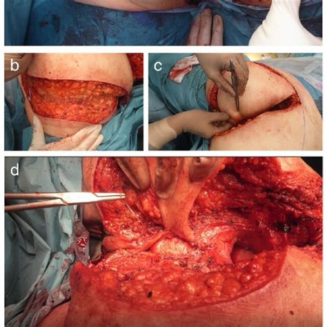 Defect Within The Pelvic Cavity Measuring 55 × 7 × 85 Cm Arrow