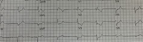 It Isnt A Stemi So Cath Lab Refusal Again Were They Right Dr Smiths Ecg Blog