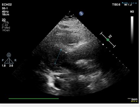 Limited 2d Echocardiogram Showing Left Ventricular Internal