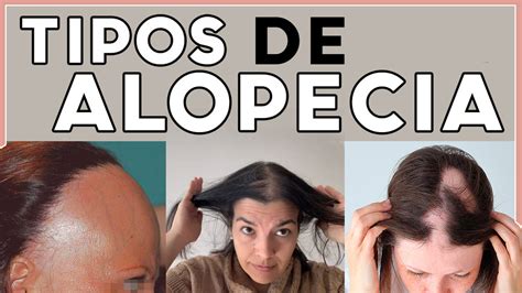 Tipos De Alopecia Nais Hair Extensiones