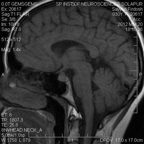 Dr Balaji Anvekar Frcr Pituitary Enlargement During Pregnancy
