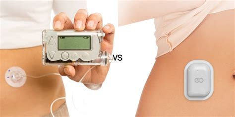 Diabetes Insulin Pumps And Patches What Are They Novi Health