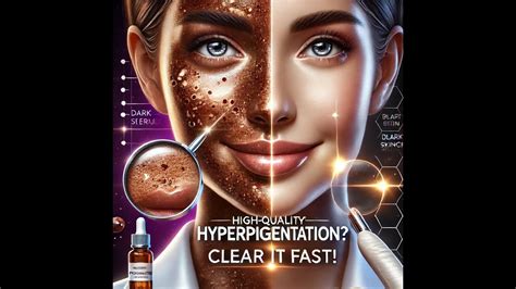 Hyperpigmentation Management Youtube