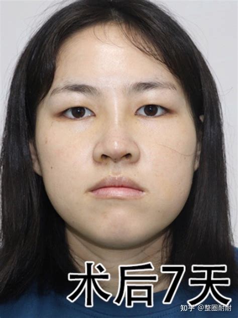 鼻部多项手术案例分享~ 知乎