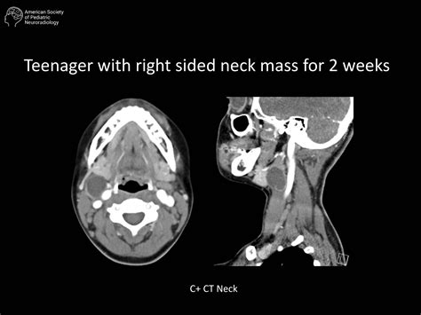 Teenager With Right Sided Neck Mass For 2 Weeks American Society Of
